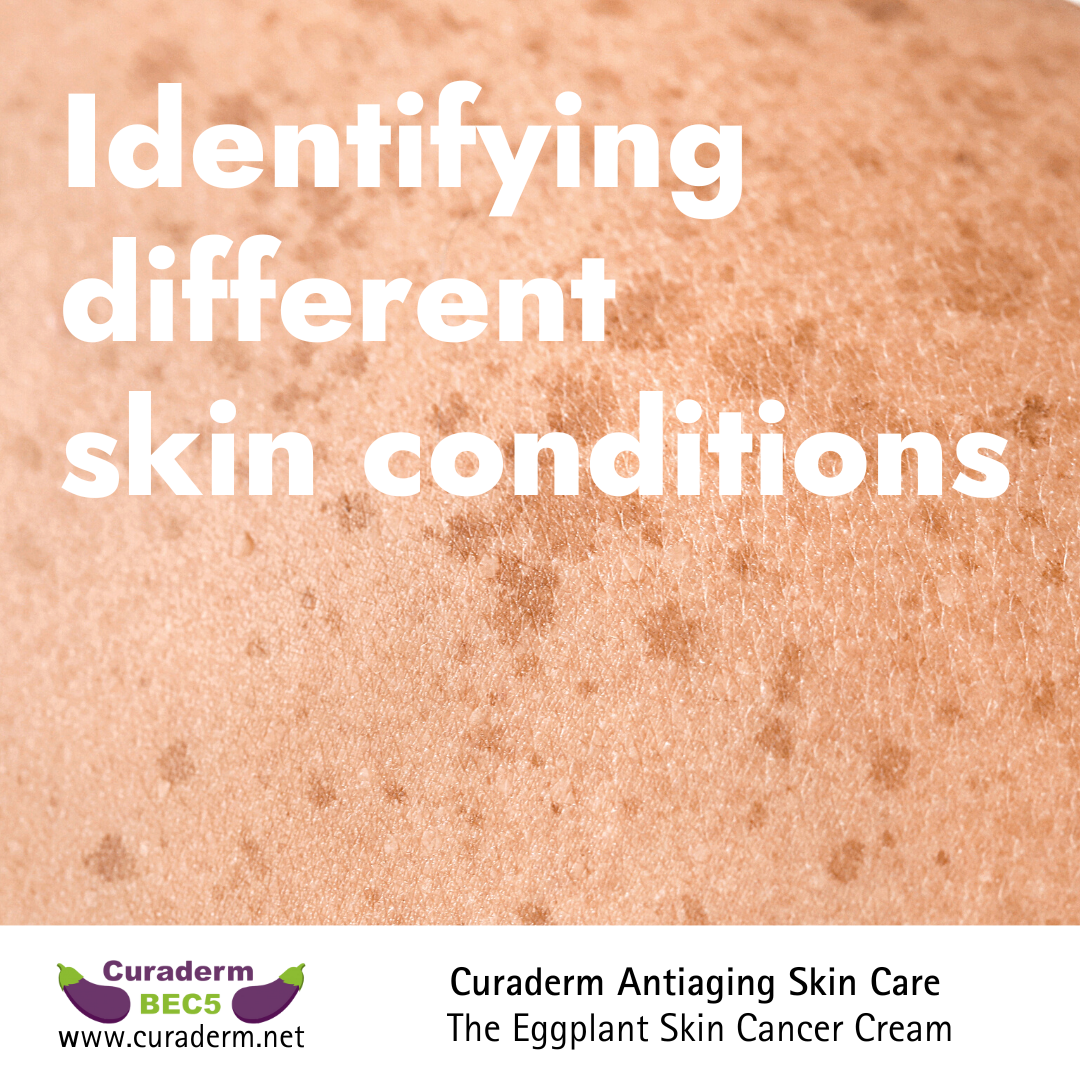 What Is the Difference Between Seborrheic Keratoses, SCC and BCC ...